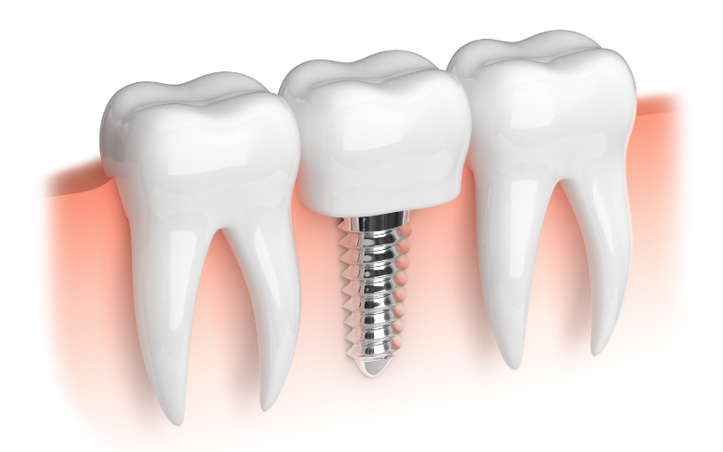 Understanding the Cost of 3 on 6 Dental Implants