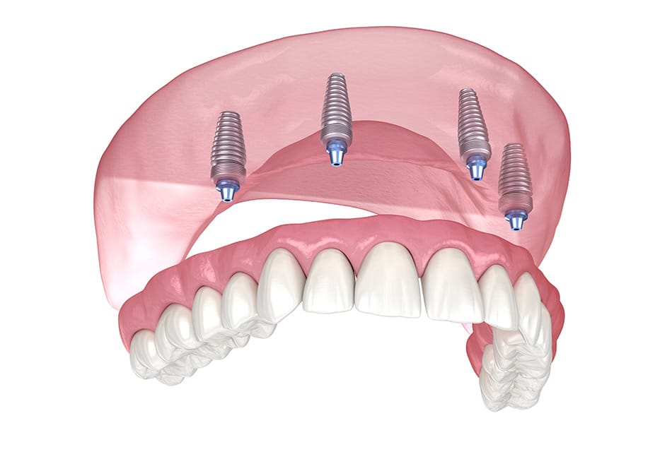 Implant Denture - Duo Dental Group