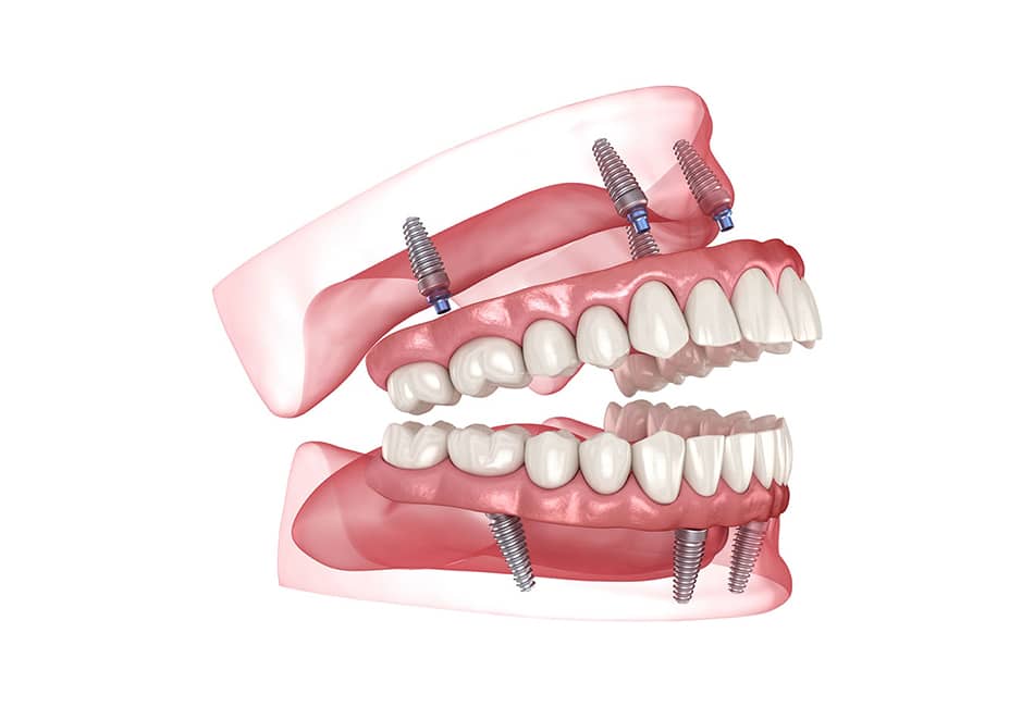 Dental Implant Procedure - Duo Dental Group