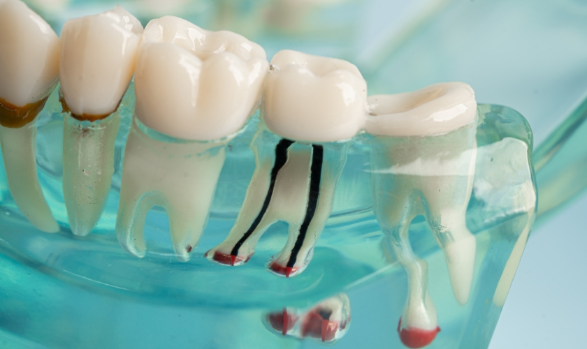 How to Handle Post-Root Canal Discomfort?